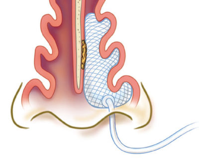 step4 | Rapid Rhino Epistaxis Device